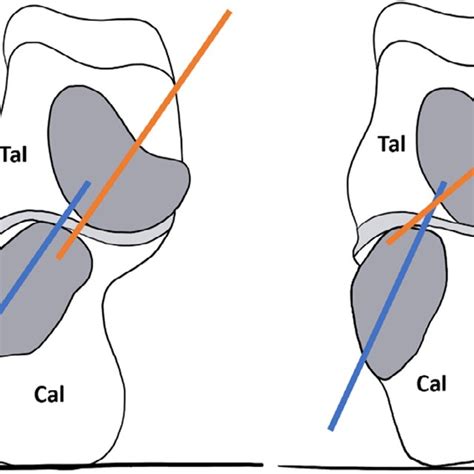 Frontal View Of Right Foot At Calcaneo Cuboid And Talo Navicular Joint Download Scientific