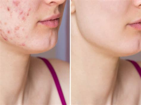 How To Get Rid Of Pimples Fast Naturally In Monsoon Try 4 Home Remedies