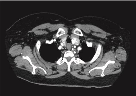 Ct Chest W Contrast Demonstrating Multinodular Goiter Download