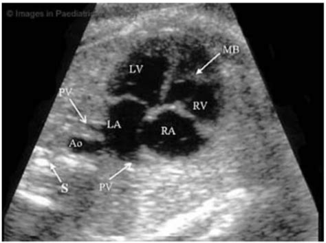 Ch 35 Fetal Echocardiography Flashcards Quizlet