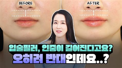 입술필러로 긴 인중을 짧아 보이게 할 수 있나요│ 입술모양에 따른 얼굴 비율 변화 Youtube