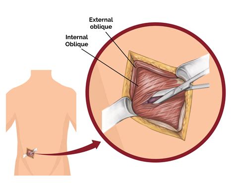 Comprehensive Guide To Appendectomy Open Surgery