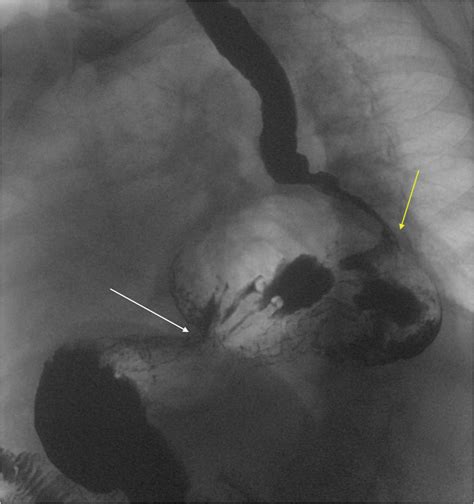 3d Intracardiac Echocardiography In Mitral Transcatheter Edge To Edge