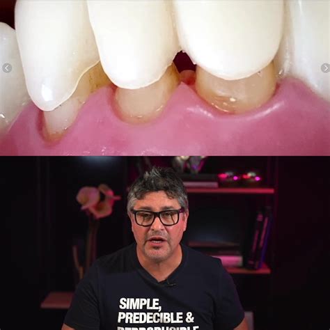 Algunas Variables Biológicas Deben Ser Consideradas En El Diseño Protésico Del Provisional