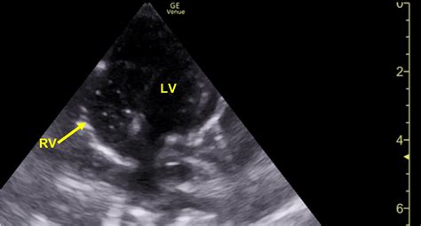 Pocus Confirmation Of Intraosseous Line Placement Visualization Of