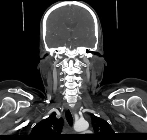 File Spectrum Of Fibromuscular Dysplasia Acute Vertebral Artery