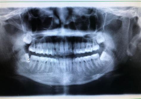 Im Getting All Four Wisdom Teeth Removed At Once 😬 Scrolller