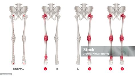 正常腿骨或中性姿勢腿骨前視紅色突出顯示關節炎髖膝踝關節疼痛 Area3d 醫學插圖人體解剖學醫學概念白色背景 照片檔及更多 人 照片 Istock