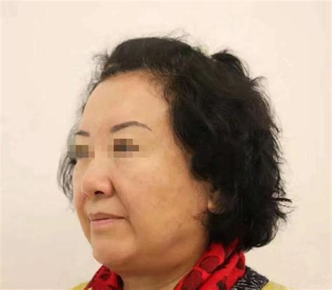 「60歲的李女士」psv面部提升術後7天，她的臉型改變最大 每日頭條