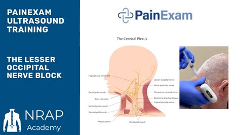 The Ultrasound Guided Lesser Occipital Nerve Block Nrap Academys