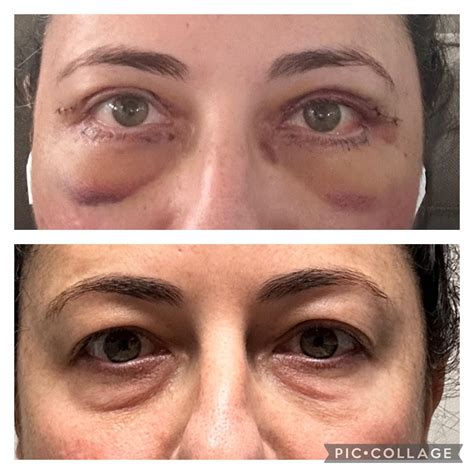Upper And Lower Bleph 5 Days Ago R Plasticsurgery