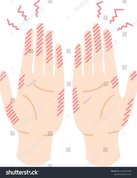 Illustration Chilblains On Hands Finger Stock Vector Royalty Free 2052553628 Shutterstock