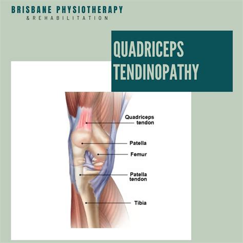 Quadriceps Tendinopathy 4 Essential Exercises For Effective Quadriceps