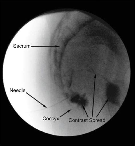 Ganglion Impar Block Anesthesia Key