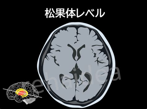 レンズ核（被殻淡蒼球）を脳画像から簡単に見つける方法 リハアイデア