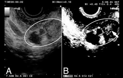Endoscopic Ultrasound Images Of A Branch Duct Intraductal Papillary