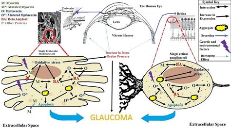 An Overview Of Glaucoma Progression And Factors Contributing To It With