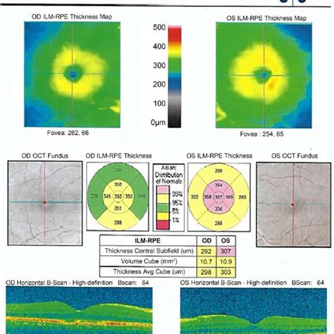 Oct Macula Showed The Central Macular Thickness Was 518 µm In The Right Download Scientific