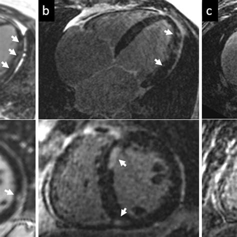 Pdf Myocardial Scar Detection In Free Breathing Dixon Based Fat And Water Separated 3d