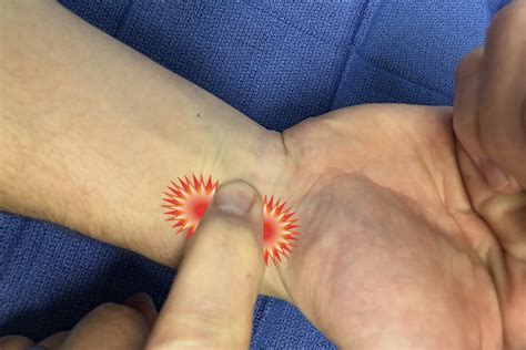 Flexor Carpi Radialis Fcr Tenderness Hand Surgery Resource