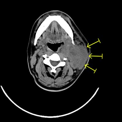 Mass Lesion In Neck I Parapharyngeal Mass Radiology Ct Scan And Mri