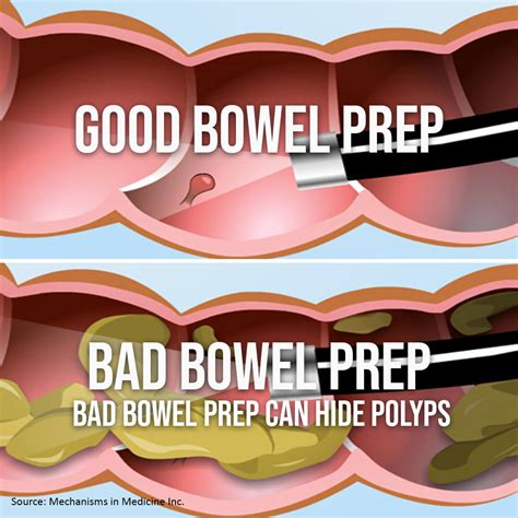 Bowel Prepartion For A Colonoscopy