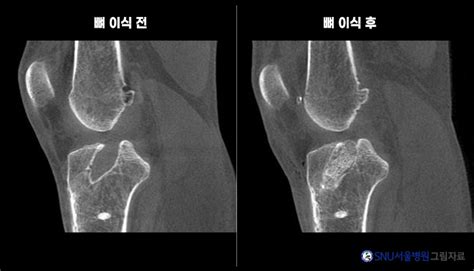 전방십자인대 수술했는데 또 파열