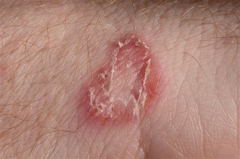 Ringworm Of The Body Healthify