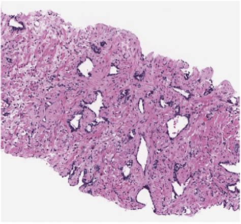 Prostate Atrophy Formalin Fixed Paraffin Embedded Stained With Hande 10Â Download Scientific