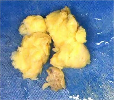 Uterine Inflammatory Myofibroblastic Tumor A Retrospective Analysis