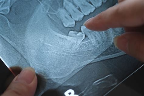 Does Wisdom Tooth Extraction Require Invasive Surgery Tysons Corner