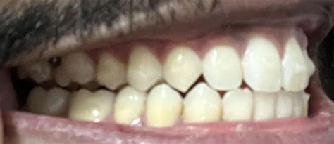 Jaw Slightly Shifted After 2 Months Of Ujs R Jawsurgery