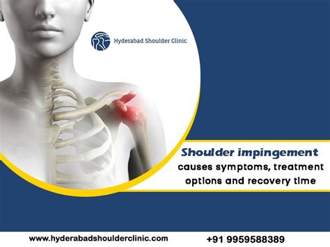 Shoulder Impingement Causes Symptoms Treatment Options And Recovery Time Shoulder Clinic