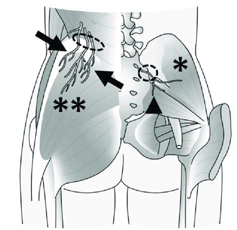 Cervical Spinal Stenosis Eorthopod Com Artofit