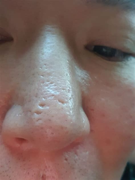 코 여드름 흉터 수술하고 싶어요 지식in