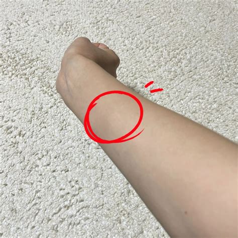 수술 지방종 제거 수술 후기수술비용 술후 관리 네이버 블로그