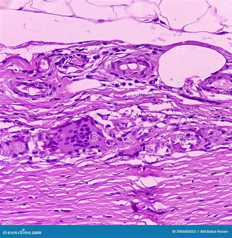 Thyroid Cancer Microscopic Image Of Follicular Neoplasm Malignant