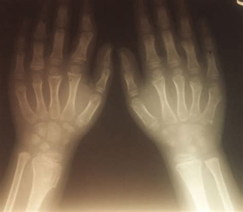 Multiple Osteochondromas Of The Hands Radiological Aspect Download