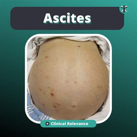 Teachmeanatomy On Twitter A Quick Recap Of Ascites 🫃 Learn More Here