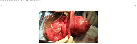 The Right Hemicolectomy Specimen Of Patient X With The Appendix Still