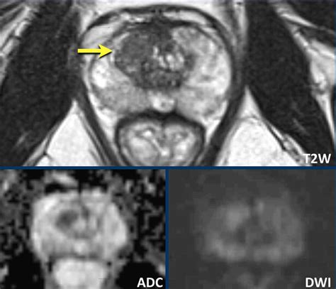 The Radiology Assistant Prostate Cancer Pi Rads V21