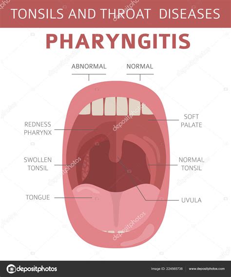 Tonsils Throat Diseases Pharyngitis Symptoms Treatment Icon Set Medical