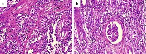 Pathology Of Renal Cell Carcinoma Oncohema Key