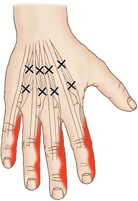 Lumbricals Manus Trigger Point Learn Muscles