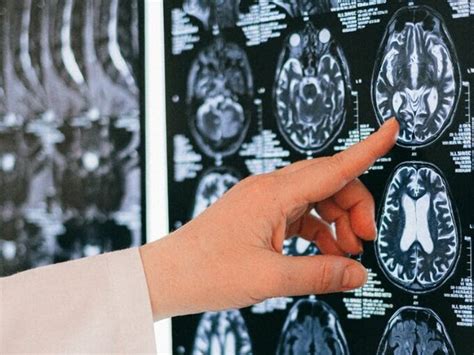 Budowa mózgu podział kliniczny i szczegółowa budowa Zdrowie Wprost