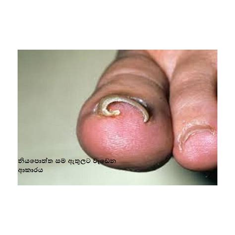 නියපොතු කෙලවර ඇතුල් පැත්තට වැවීම