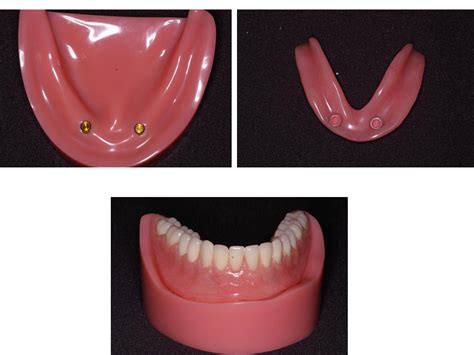 Over Denture Over Partial Denture Ask A Dentist