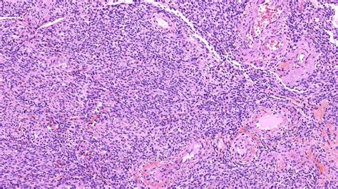 零基础病理 子宫平滑肌瘤（附高清图鉴赏） 海南省生物材料与医疗器械工程研究中心