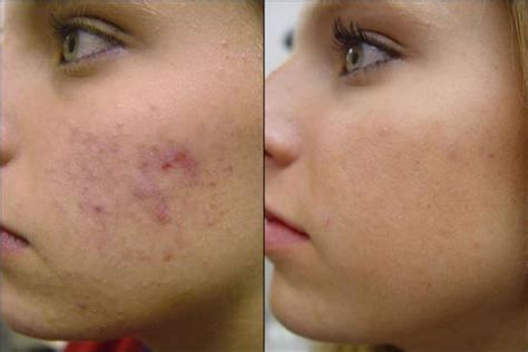 Health Second How To Clear Acne Scars Naturally
