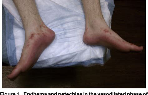 Figure 1 From Clinical Communications Adults Immersion Foot A Case